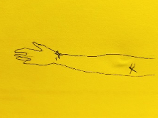 Poor Circulation in the Extremities